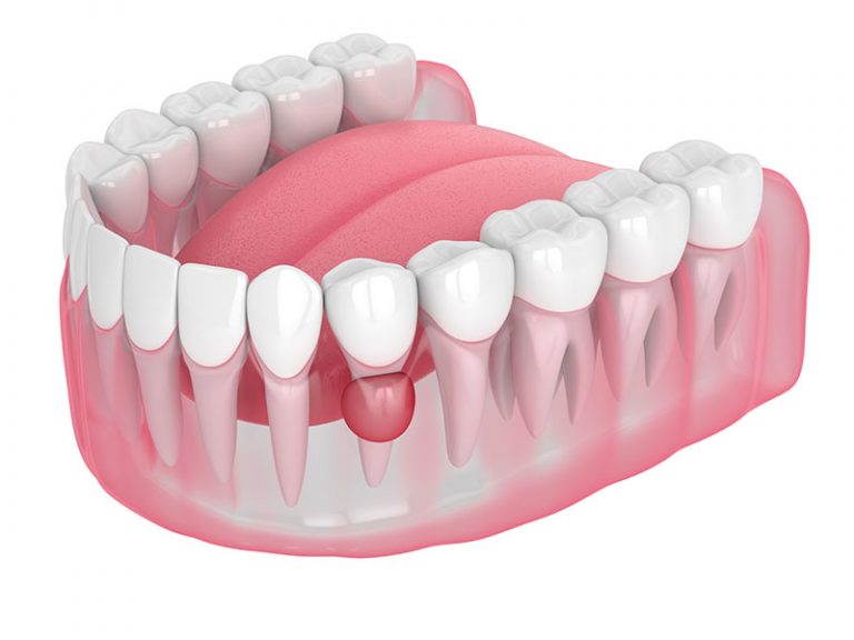 Cos'è il granuloma dentale e cosa fare? - Rivista La Salute