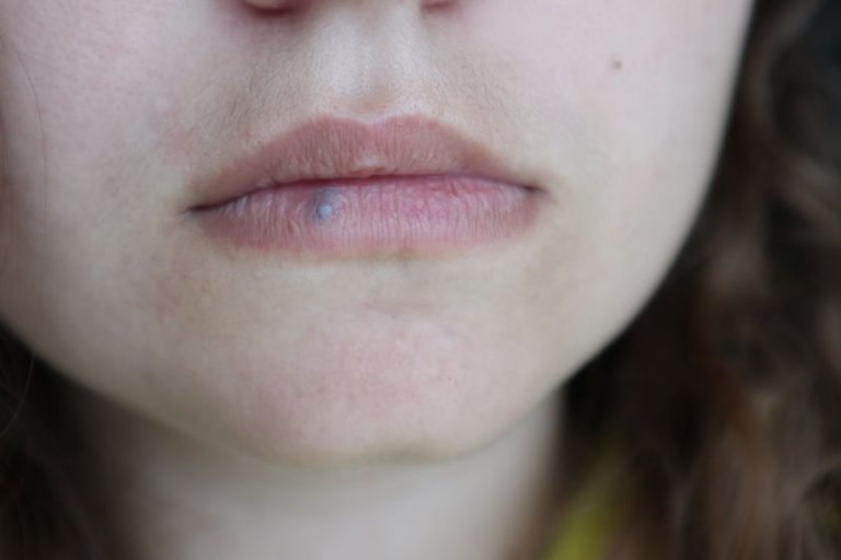 Angioma labbro: cause, sintomi, trattamento - Rivista La Salute